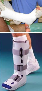 Midfoot (Tarsometatarsal) Fusion - Dr Greg Sterling