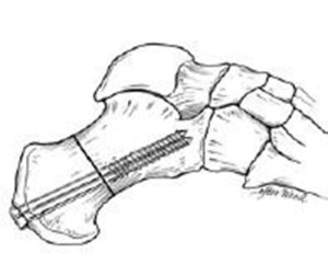 Cavovarus Foot Correction - Dr Greg Sterling