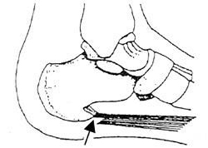 Surgery for Plantar Fasciitis - Dr Greg Sterling