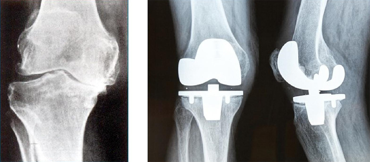 Knee Replacement - Dr Greg Sterling